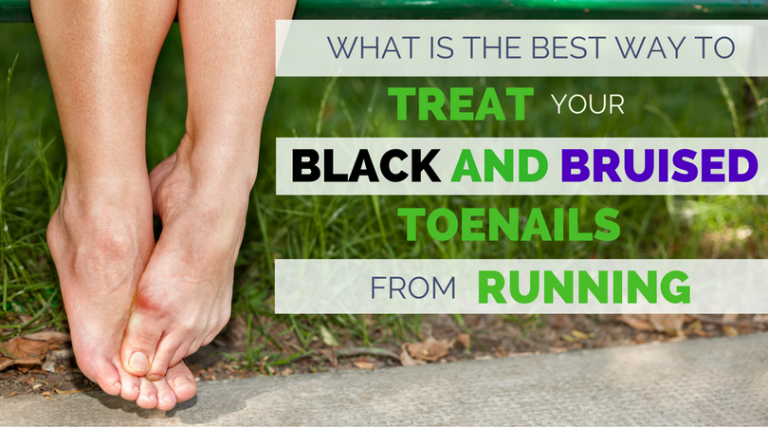 What is the Best Way to Treat Black and Bruised Toenail from Running ...